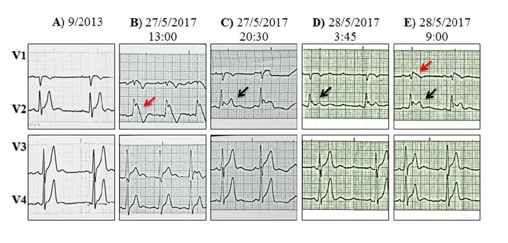 Variabilidad del patrón electrocardiográfico en un paciente con ...