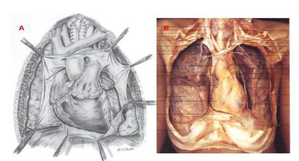 Derrame Pleural Con Catéter Pigtail